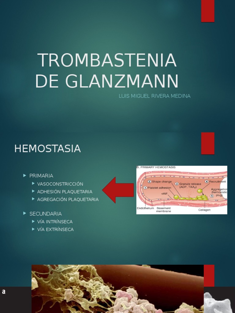 Trombastenia de Glanzmann: Diagnóstico y Tratamiento | PDF