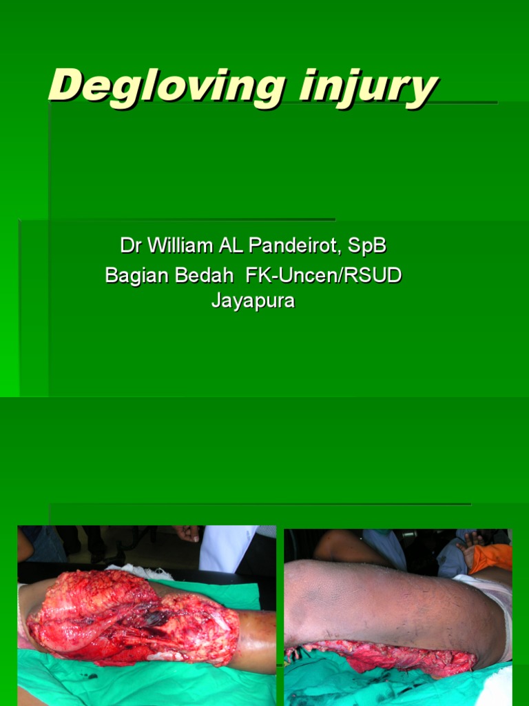Degloving Injury | PDF