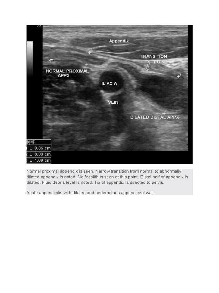Normal Proximal Appendix Is Seen | PDF