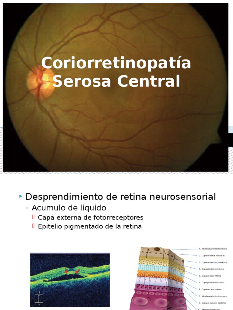 Coriorretinopatía Serosa Central | Retina | Percepción visual