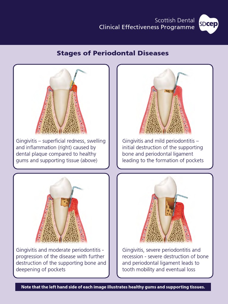 Stages of Periodontal Diseases: Scottish Dental Clinical Effectiveness ...