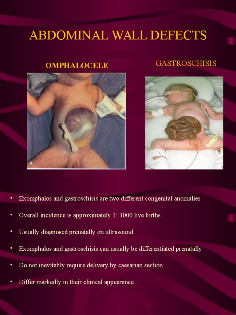 Abdominal Wall Defects | PDF | Congenital Disorder | Health Sciences