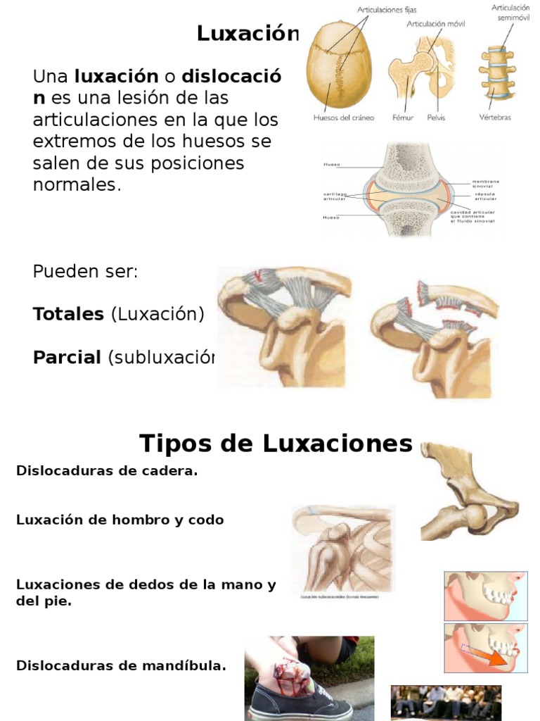Luxacion o dislocacion