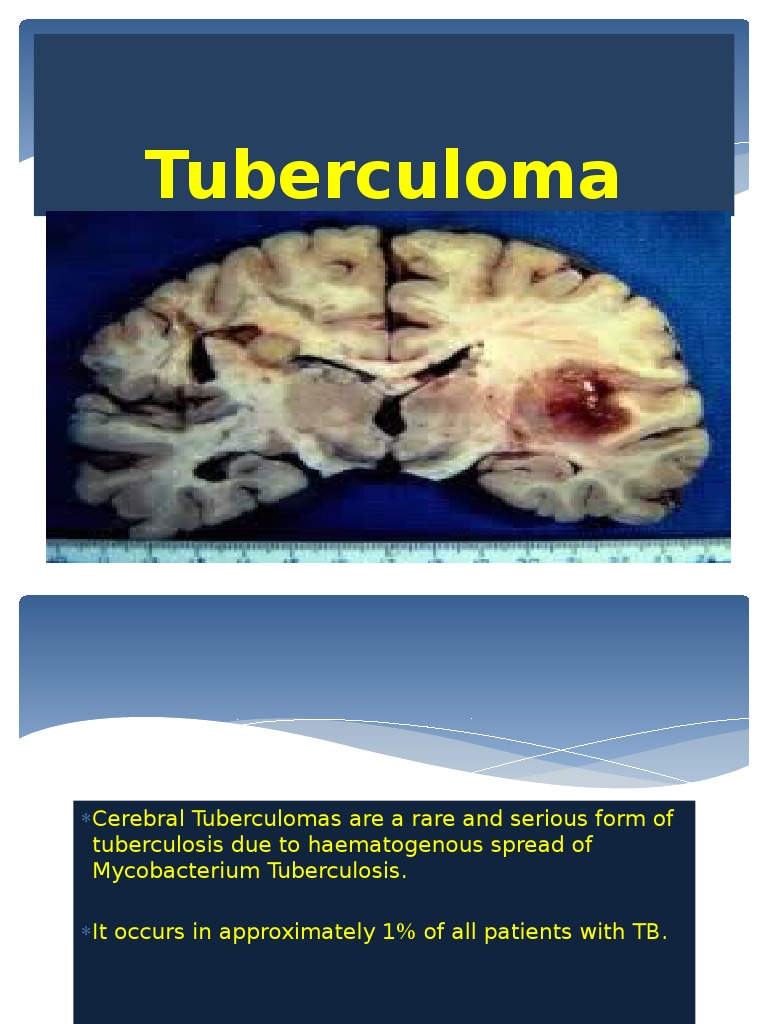 Tuberculoma