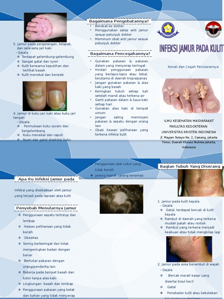 Gejala dan Pengobatan Infeksi Jamur Kulit | PDF