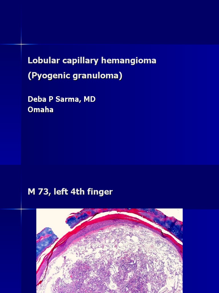 Lobular Capillary Hemangioma (Pyogenic Granuloma) - M 73, Left 4th ...