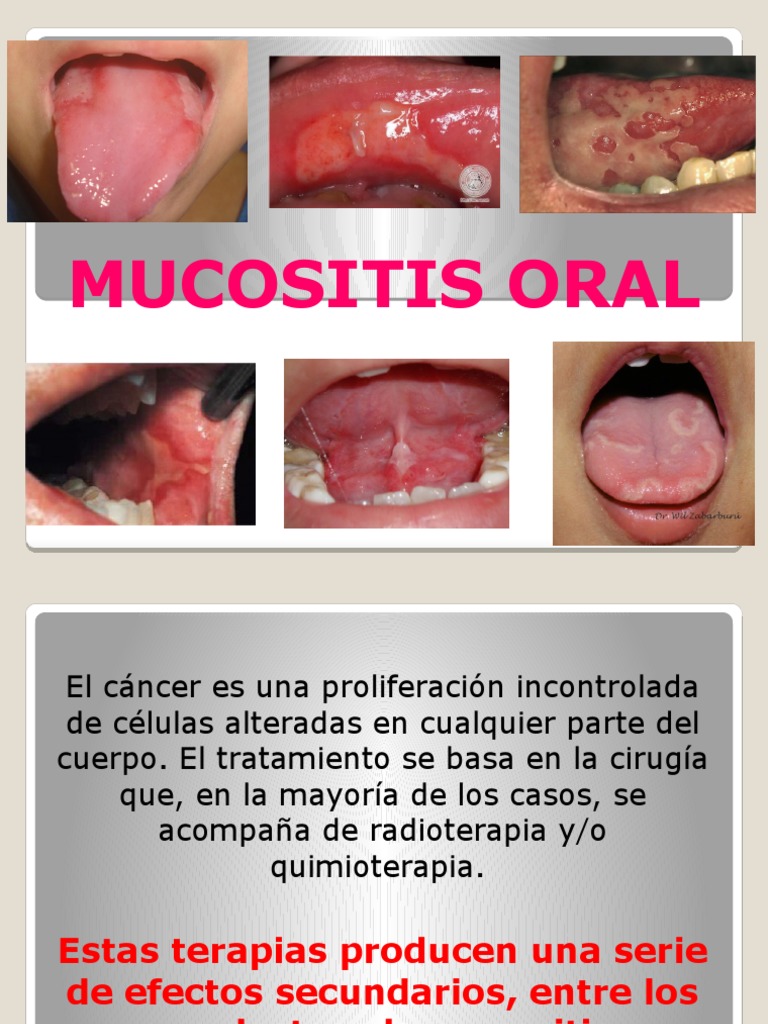 Mucositis | PDF