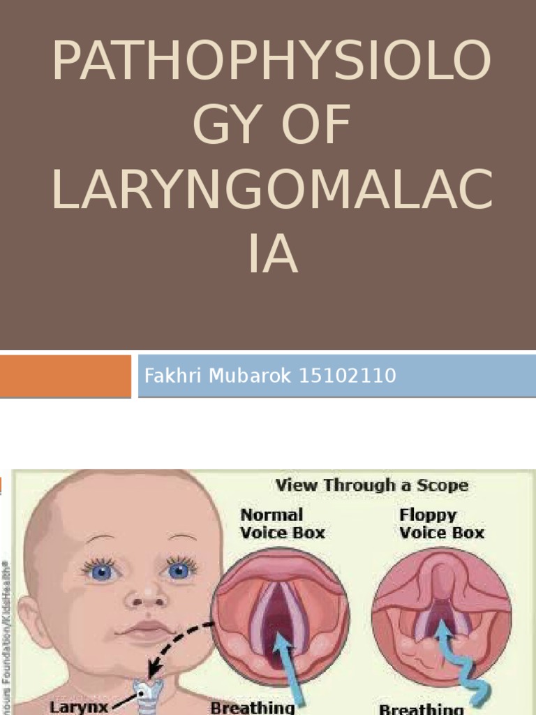 Patofisiologi Laringomalasia | PDF