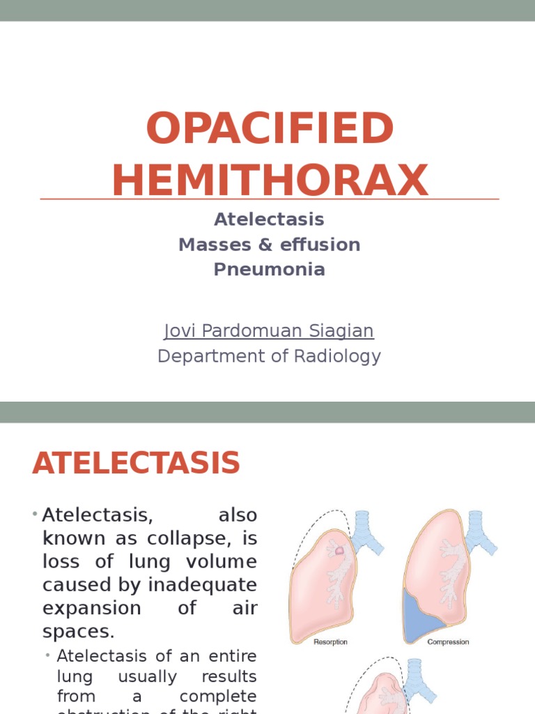 Opacified Hemithorax: Atelectasis Masses & effusion Pneumonia ...