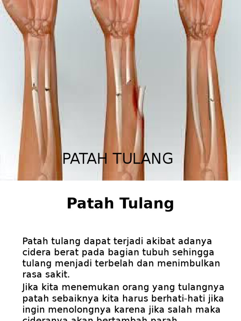 Patah Tulang