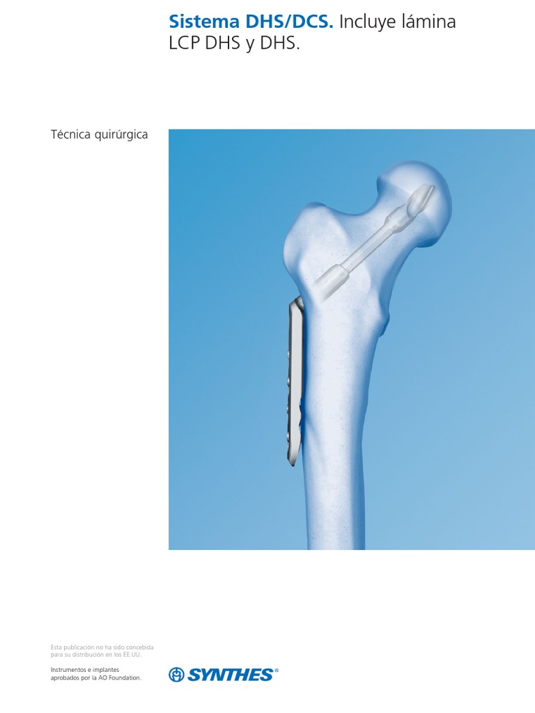 Articulo Sistema DHS DCS FX Cadera PDF | PDF | Tornillo | Sistema ...