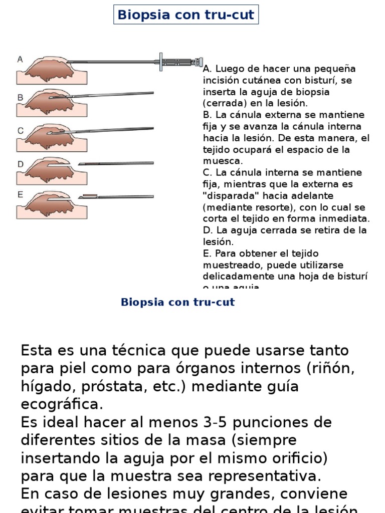 Biopsia con Aguja Tru-Cut: Protocolo y Cuidados | PDF | Biopsia | Sarcoma