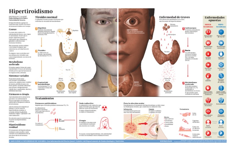 Hiper Hipo Tiroidismo | PDF | Hipertiroidismo | Tiroides