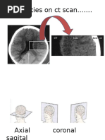 Reading Normal Head CT Scans | PDF | Ct Scan | Parietal Lobe