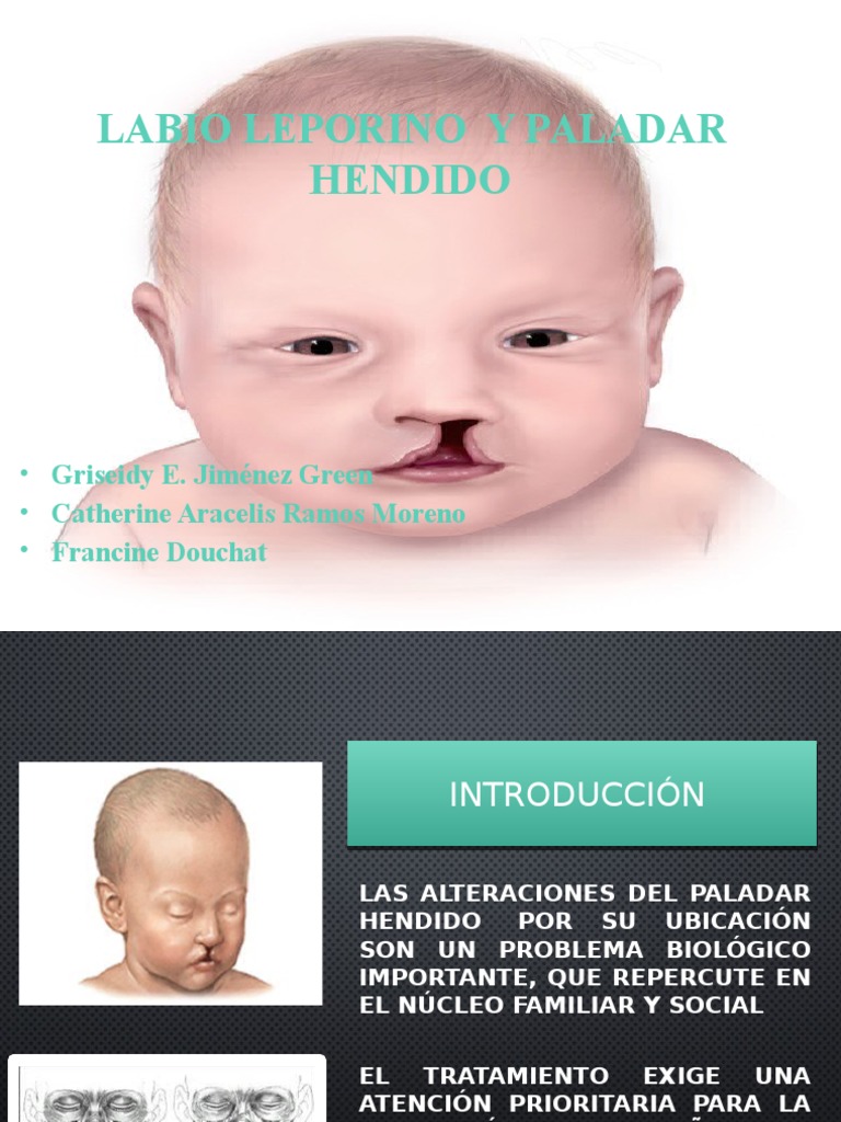 Labio y Paladar Hendido | PDF
