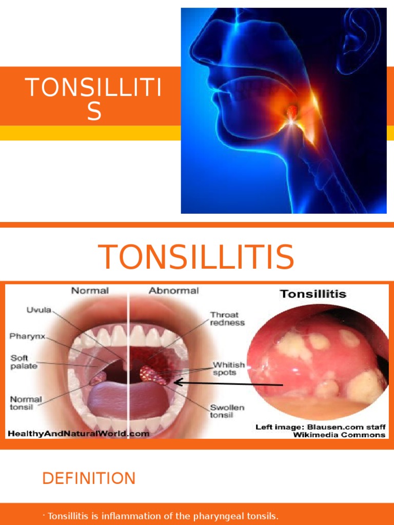 Tonsillitis | PDF | Streptococcus | Immunology