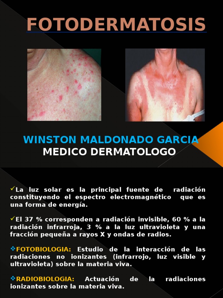 Medicina III - Fotodermatosis | PDF | Ultravioleta | Radiación ...