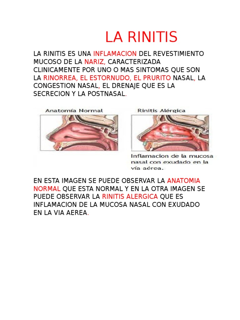 La Rinitis | PDF