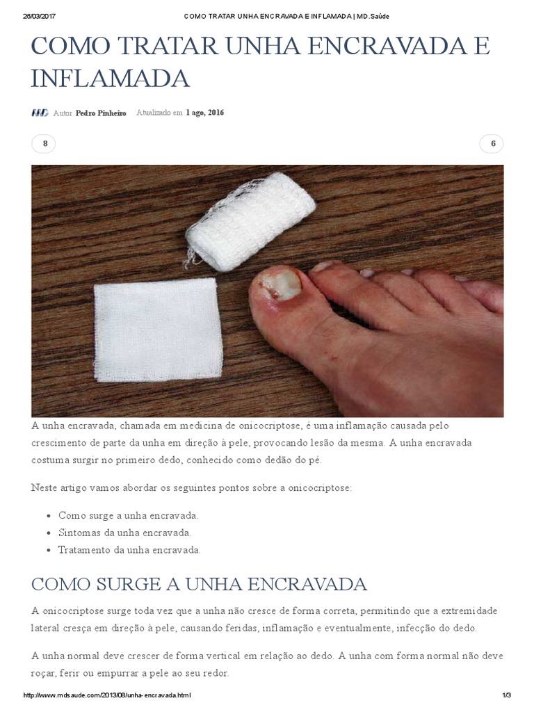 Como reconhecer, tratar e prevenir uma unha encravada e inflamada | PDF ...