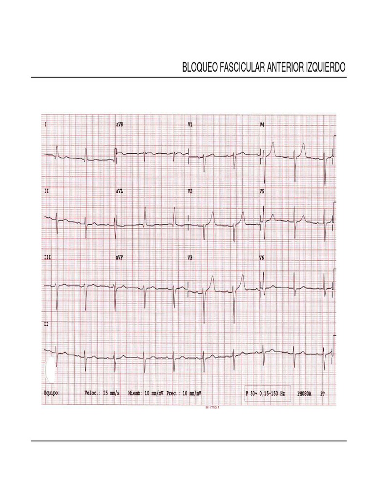 BLOQUEO FASCICULAR ANTERIOR IZQUIERDO.pdf