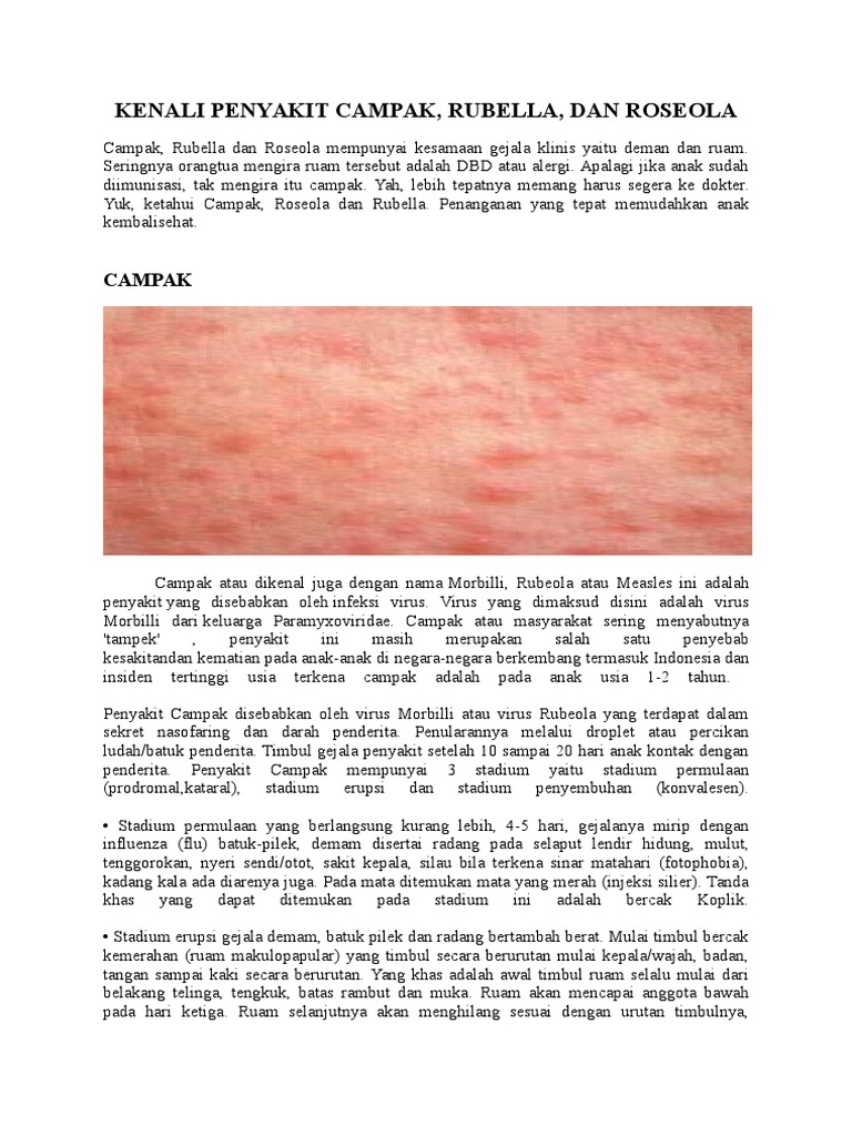 Kenali Penyakit Campak, Rubella, Dan Roseola | PDF