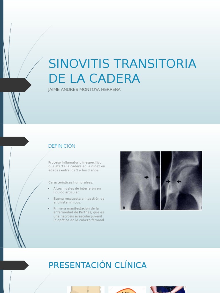 Sinovitis Transitoria de La Cadera | PDF | Rodilla | Especialidades Medicas