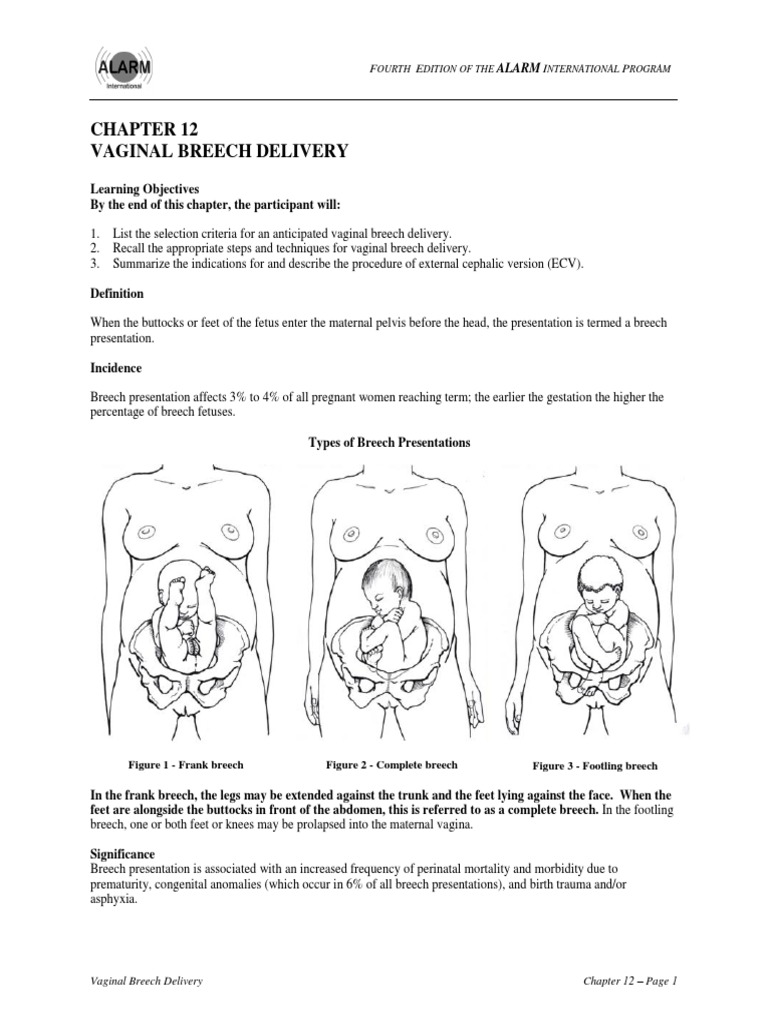 Vaginal Breech Delivery Techniques | PDF | Caesarean Section | Childbirth