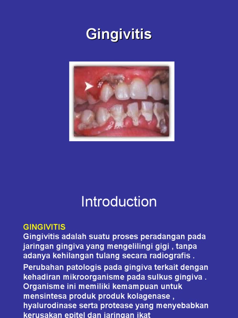 Gingivitis | PDF