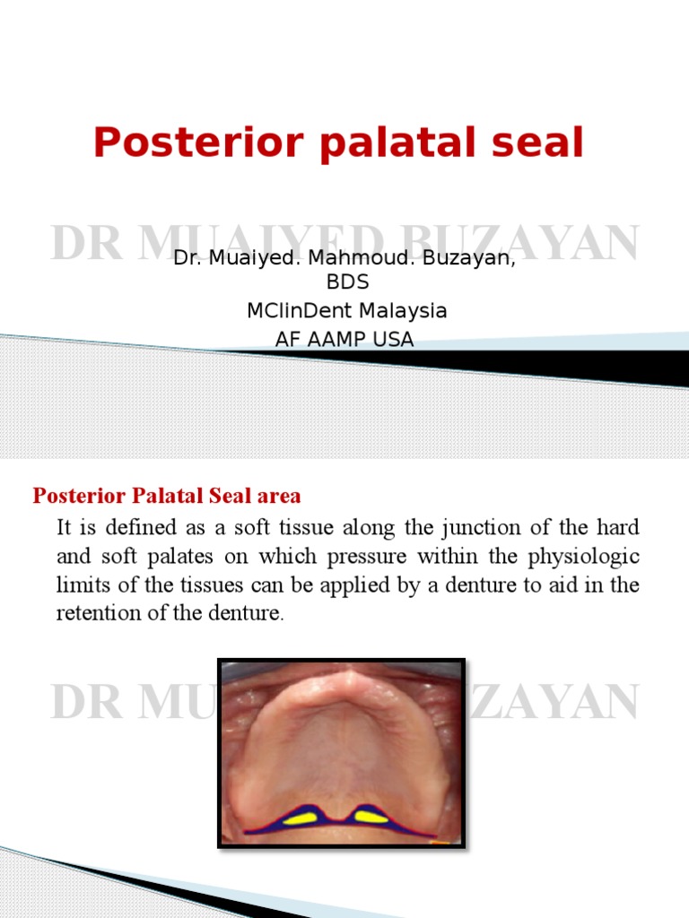 Posterior Palatal Seal
