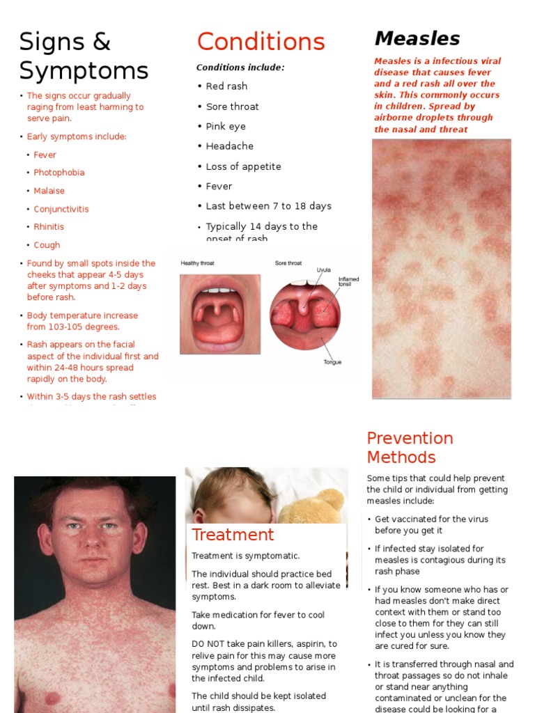Measles Brochure | PDF | Measles | Infection