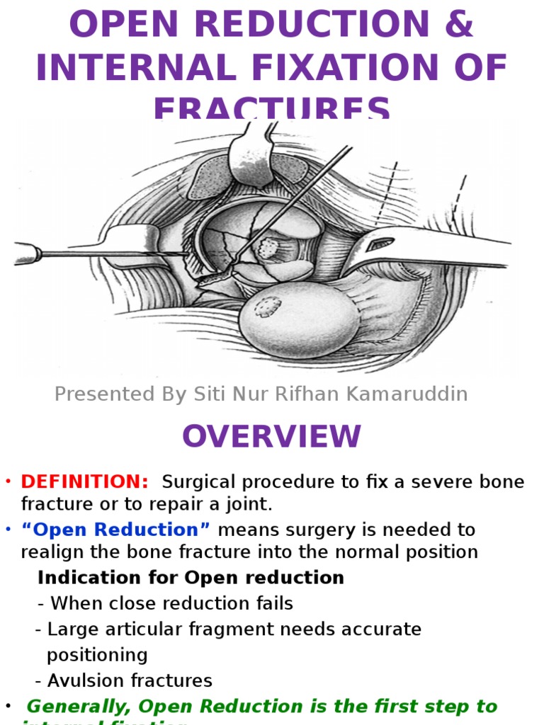 Open Reduction Internal Fixation Rif | PDF | Implant (Medicine) | Surgery