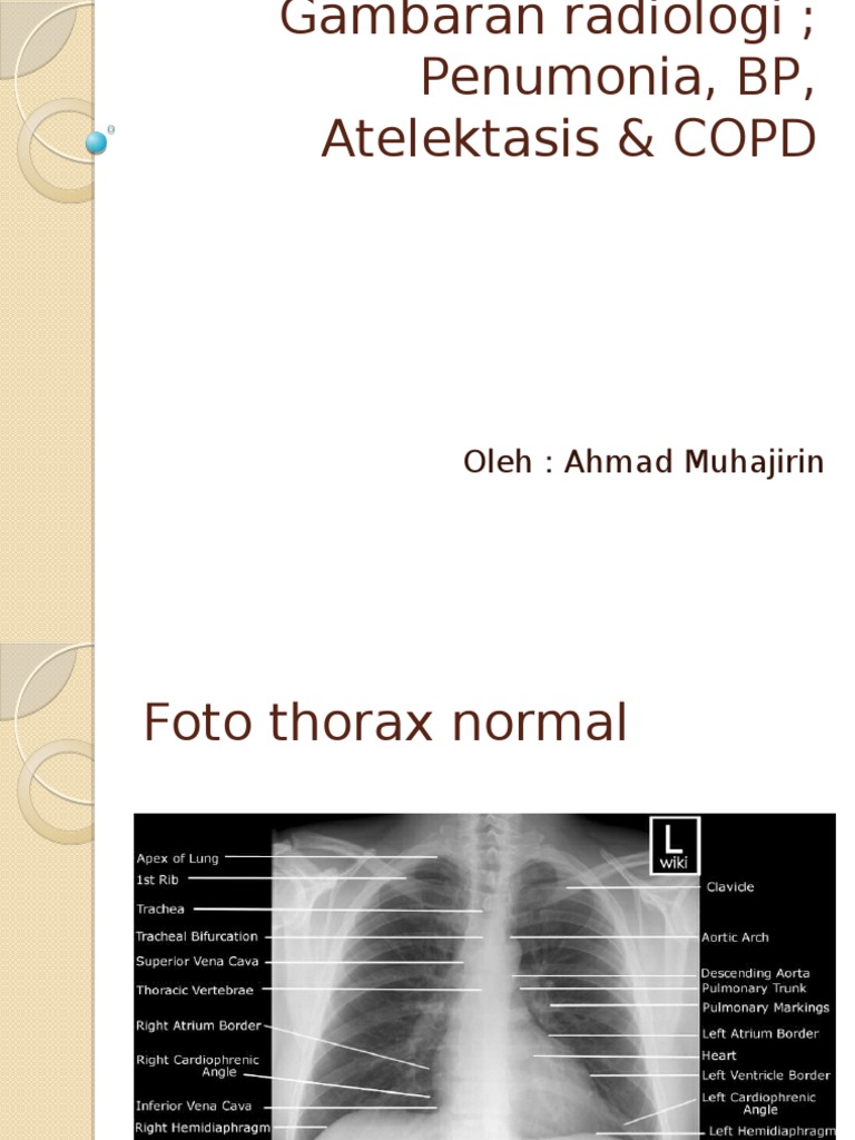 Gambaran Radiologi Thorax | PDF | Chronic Obstructive Pulmonary Disease ...