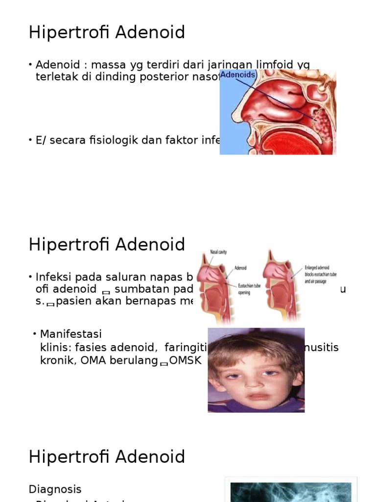 Hipertrofi Adenoid | PDF