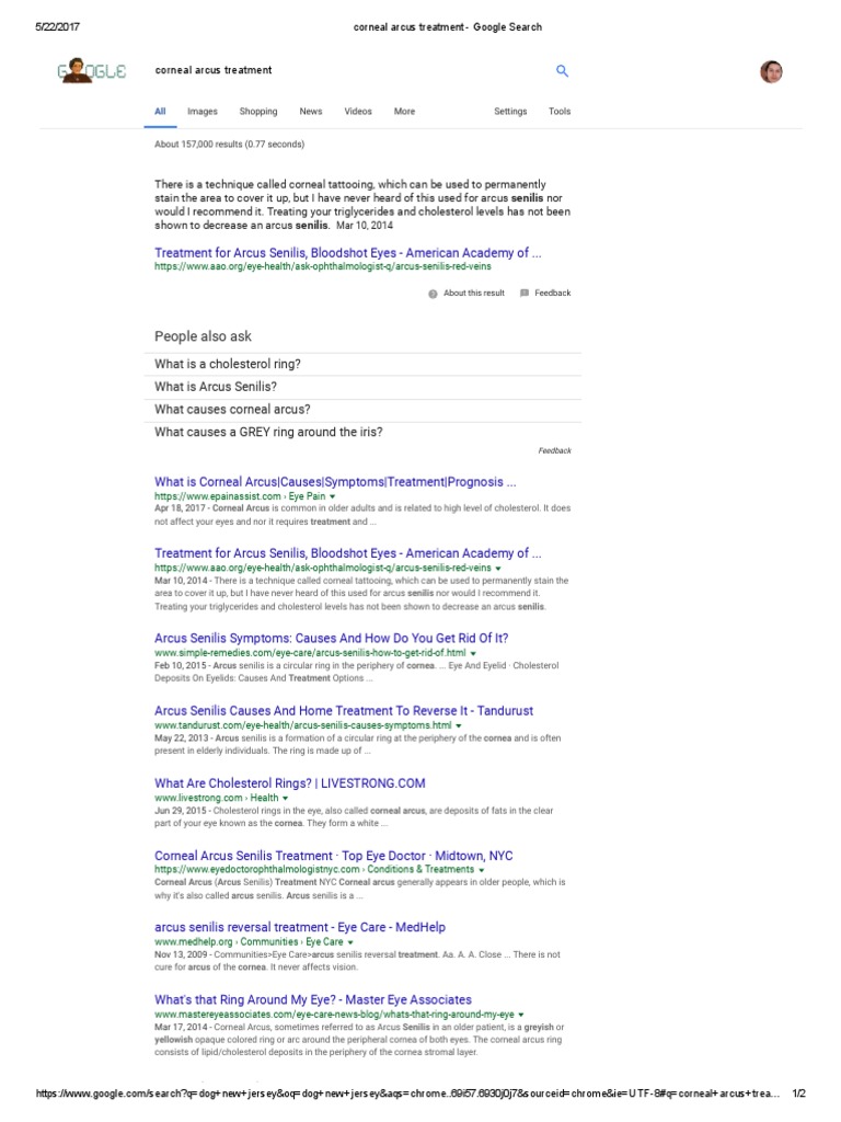 Corneal Arcus Treatment | PDF | Cornea | Ophthalmology