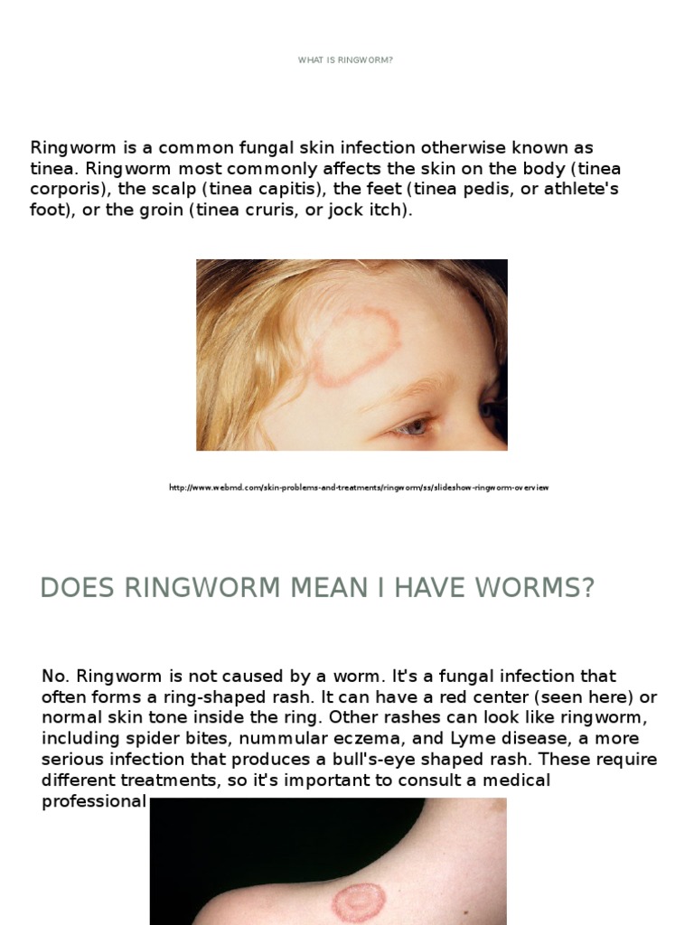 Ringworm | PDF | Cutaneous Conditions | Dermatology