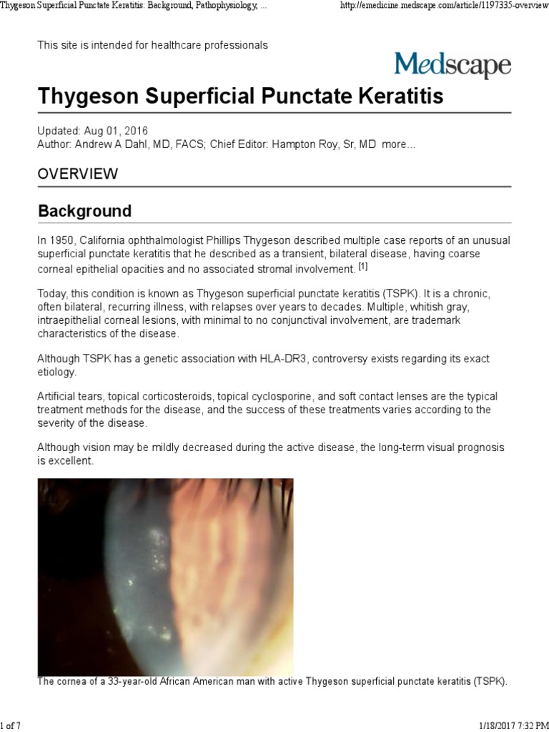 Thygeson Keratitis | Ophthalmology | Optometry