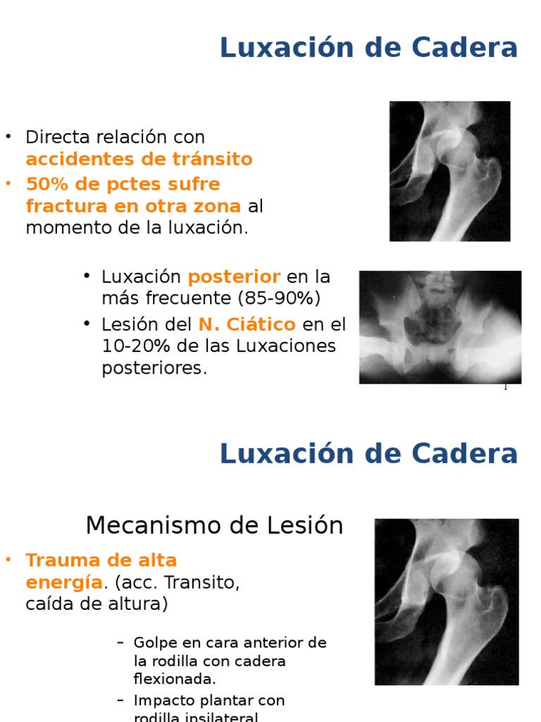 Luxaciones De La Rodilla – Luxación de la rótula y tratamiento ...
