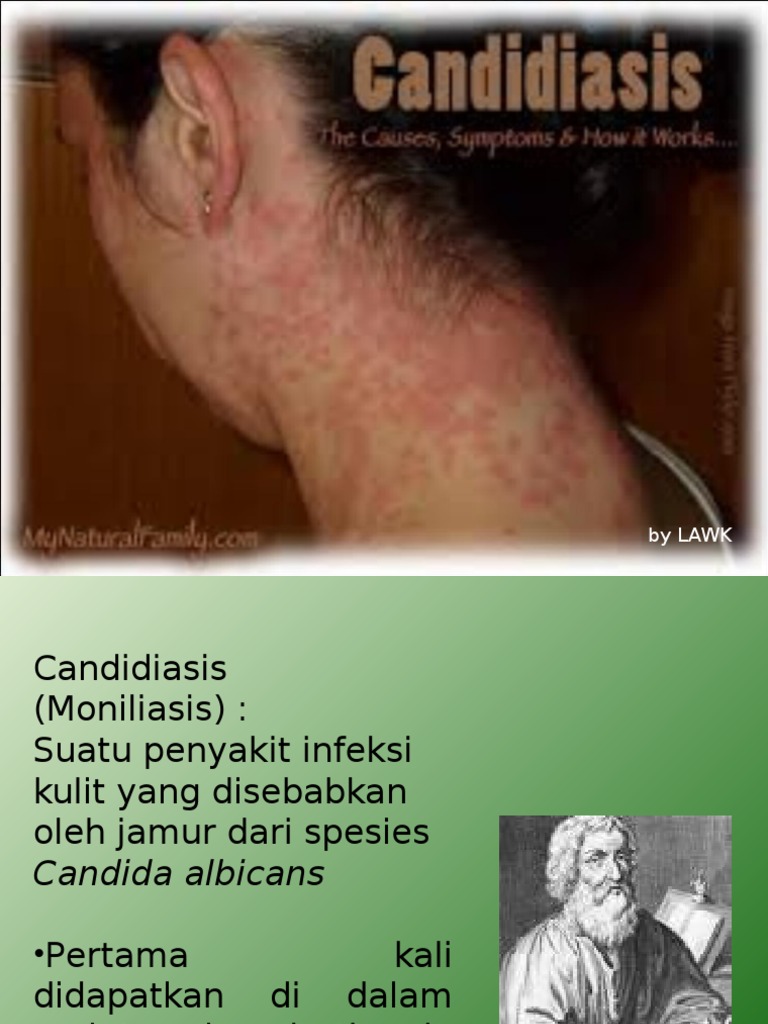 Candidiasis Mikologi | PDF