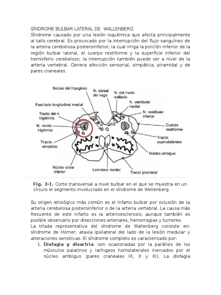 SÍNDROME BULBAR LATERAL DE WALLENBERG | Infarto de miocardio | Carrera ...