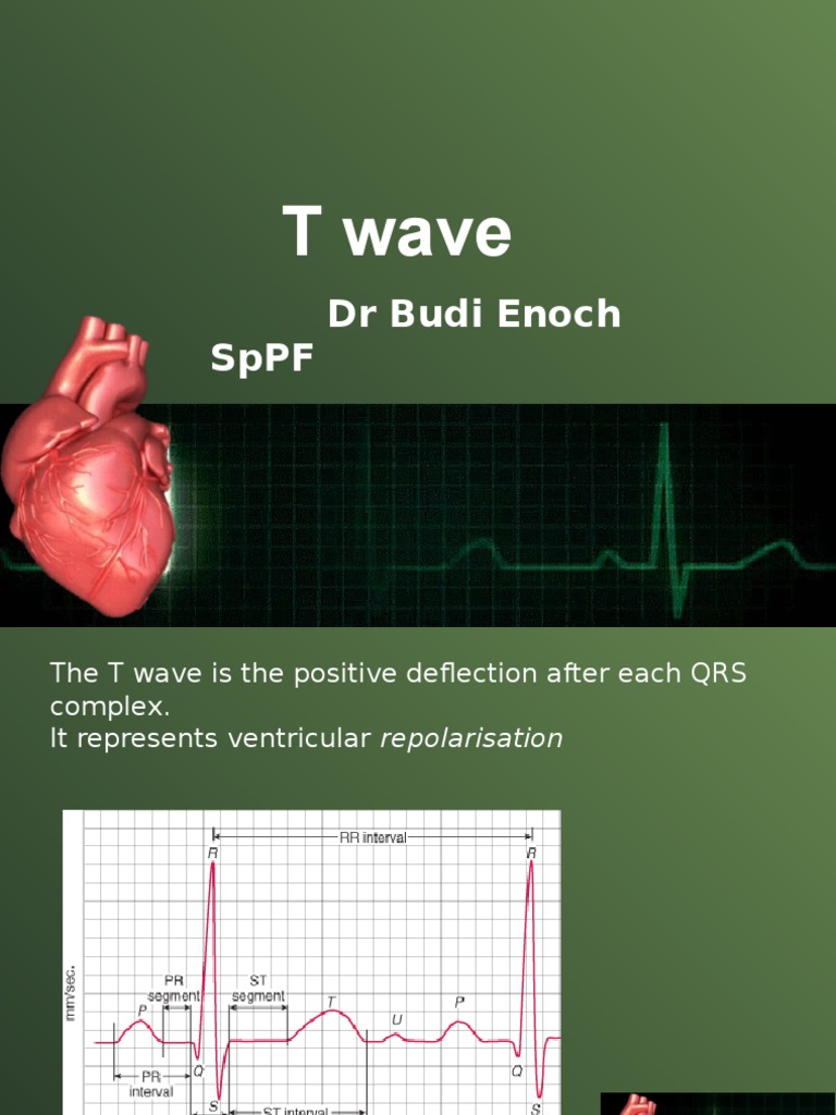 3 T Wave BH VG VF | PDF | Electrocardiography | Cardiology