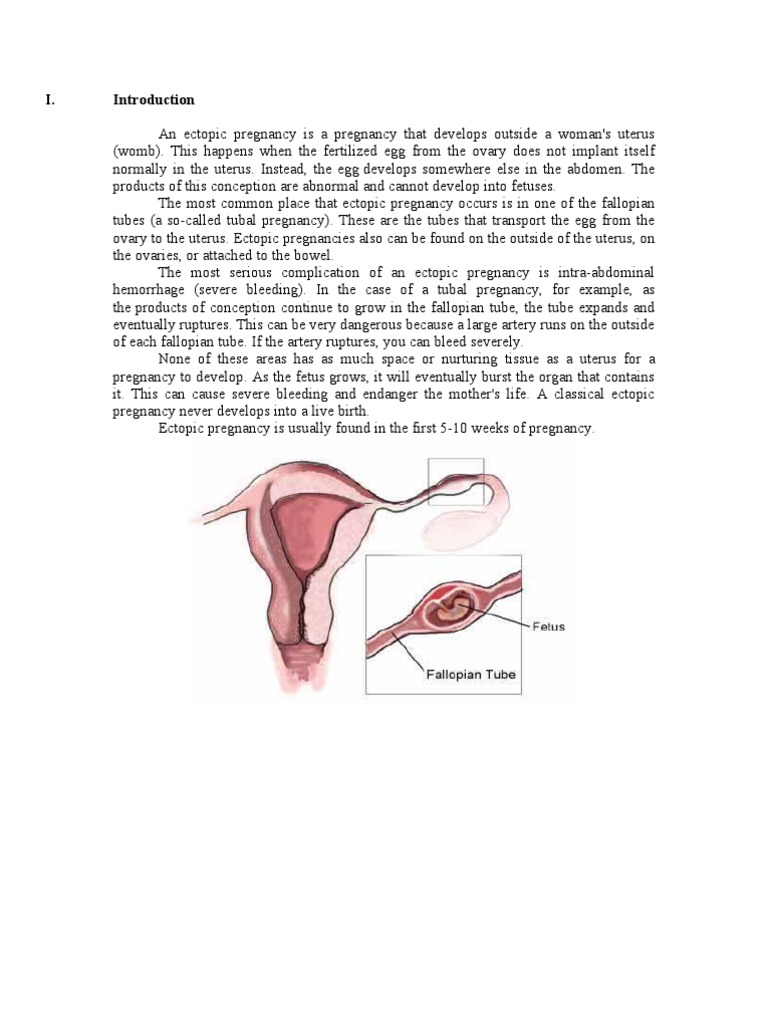 Ectopic Pregnancy - CS | Download Free PDF | Medical Specialties ...