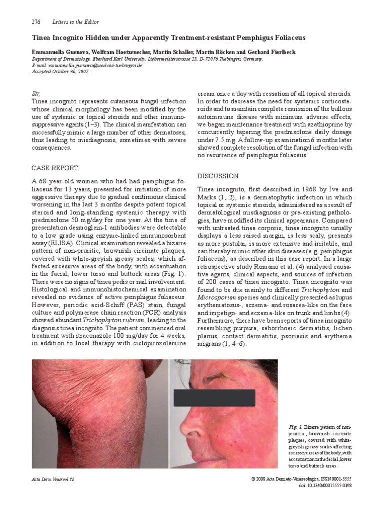 Tinea Incognito Hidden Under Apparently Treatment-Resistant Pemphigus ...