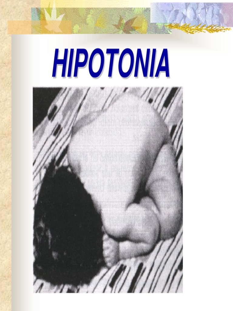 Hipotonía PDF | PDF
