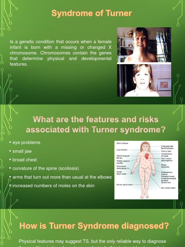 Turner Syndrome | PDF