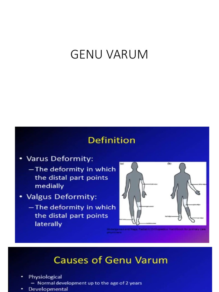 Genu Varum | PDF