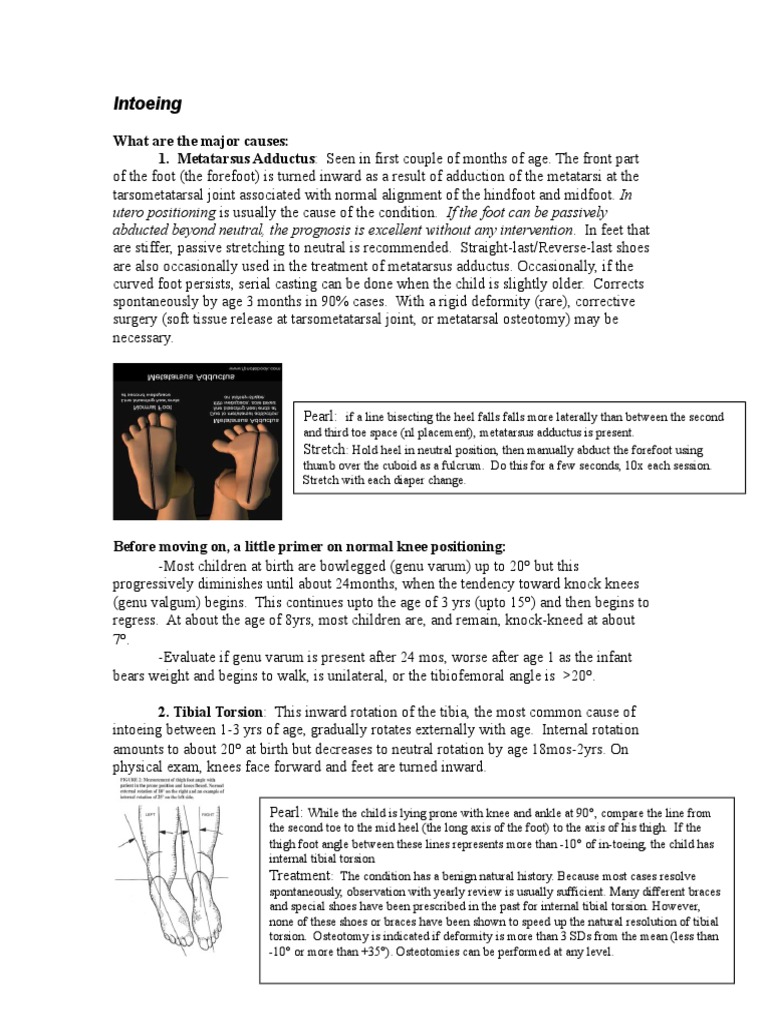 Intoeing: What Are The Major Causes: 1. Metatarsus Adductus: Seen in ...