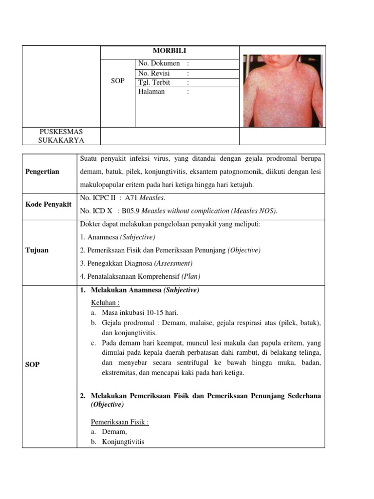 SOP Morbili | PDF