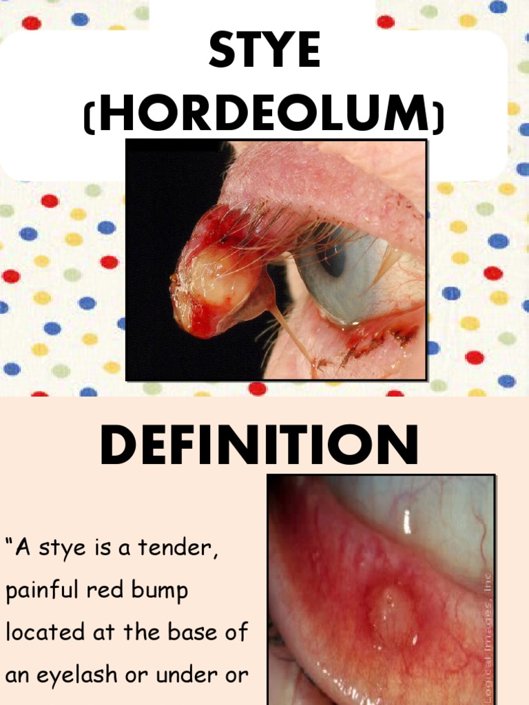 Stye | PDF | Medical Specialties | Human Eye
