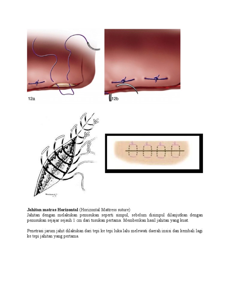 Teknik Jahitan Matras Horizontal | PDF