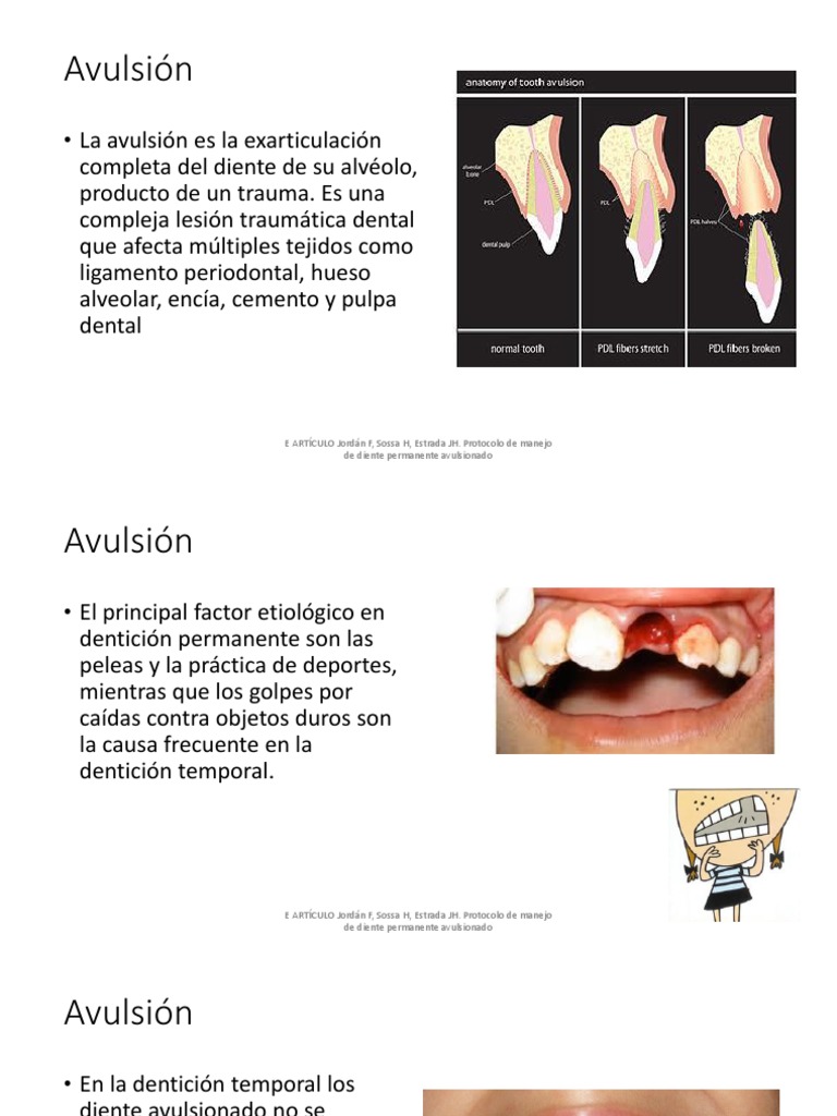 Avulsion dental